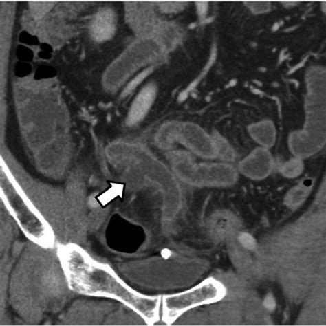 Preoperative Ct Imaging Findings An Enlarged Perforated Appendix With