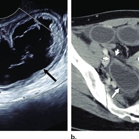 Rectal Duplication Cyst In A 43 Year Old Woman Who Presented With Download High Resolution