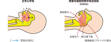 睡眠時無呼吸症候群 Online Mews