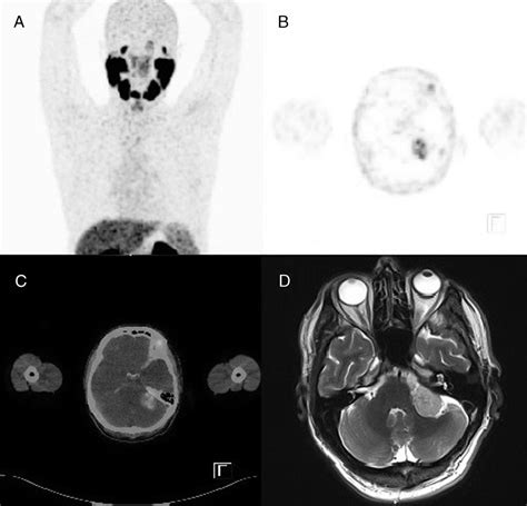 Incidental Meningioma With Altered Psma Expression After Sys