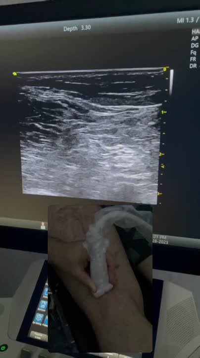 Ayad Salman On Linkedin Demonstration Of Sciatic Nerve And Its