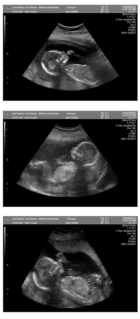 17 Week Pregnancy Ultrasound Ultrasounds