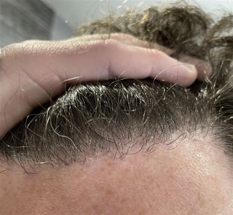 Hlc Ankara 6 Month Update 2753 Grafts Rhairtransplants