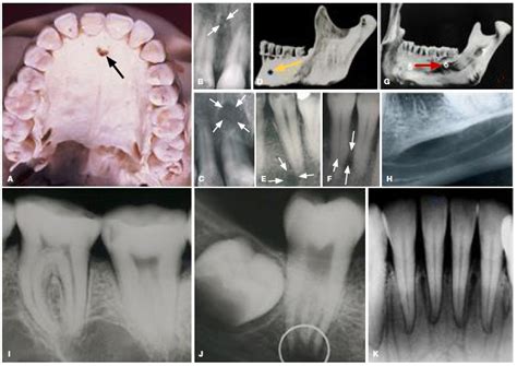 Incisive Canal Radiograph Anterior Loop Of The Mental Nerve And Its