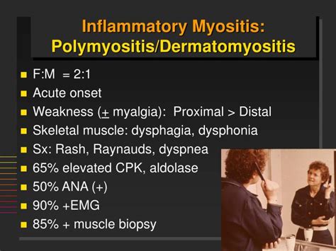 Ppt Scleroderma And Inflammatory Myositis Powerpoint Presentation Id 393300