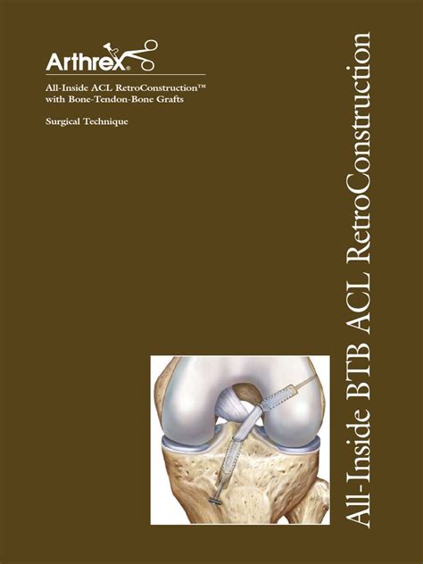 Arthrex All Inside Acl Repair Btb Pdf Knee Musculoskeletal System