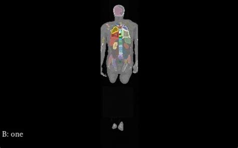 Ali Soultan On Linkedin Radiotherapy Cancer Computervision Monai Pytorch Machinelearning