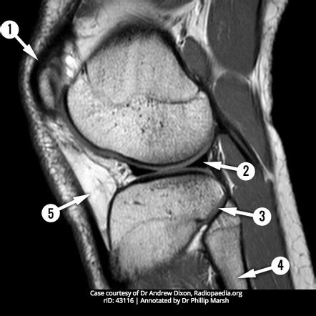 Knee Anatomy Mri