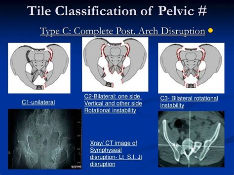 Ppt Pelvic Fractures Powerpoint Presentation Free Download Id9489131