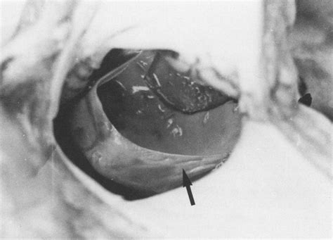 Intraoperative Pulmonary View Of The Xenograft Monocusp Patch Arrow Download Scientific