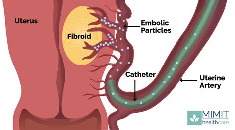 What Size Of Fibroid Is Dangerous Mimit Health