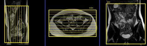 Appendix Mri Appendix Mri Protocol And Planning