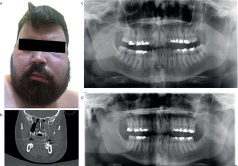 Maxillary Fracture Classification