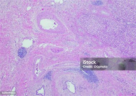 Kolangitis Sklerosis Primer Foto Stok Unduh Gambar Sekarang Amerika