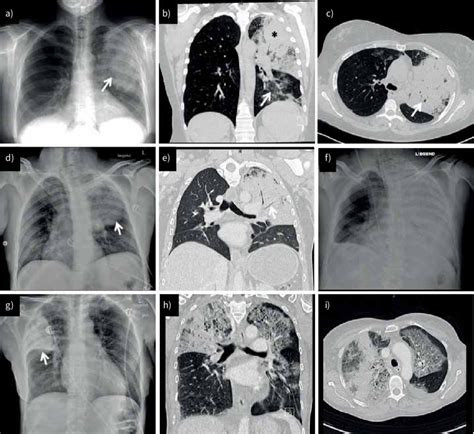 A Chest Radiograph Cxr Of A Patient With Streptococcus Pneumonia Download Scientific Diagram