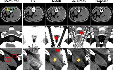 Figure 1 From A Dual Energy Metal Artifact Redcution Method For Dect Image Reconstruction
