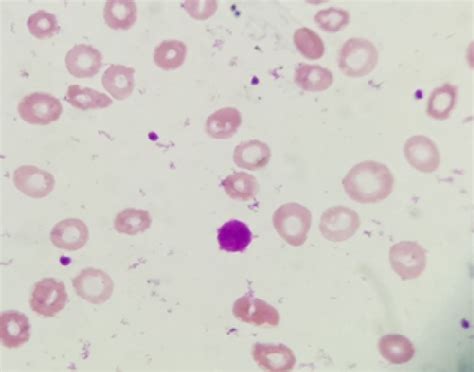 Figure 3 From Platelet Distributionwidth Pdw A Novel Platelet Marker In Thrombocytosis An