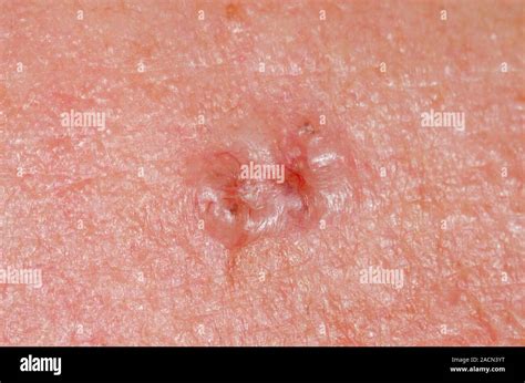 Close Up Of Basal Cell Carcinoma Bcc Or Rodent Ulcer On The Skin Of The Forehead In A 68