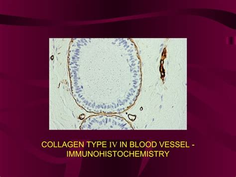Podoplanin And Its Role In Diagnosis Of Cancer Invasion Ppt