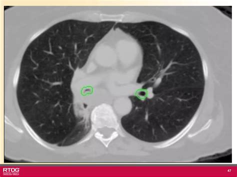 Rtog 1106 Oar Atlas Thoracic Radiation Therapy Ppt