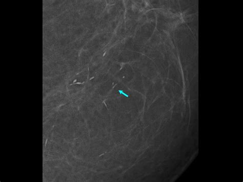 Atlas Of Breast Cancer Early Detection