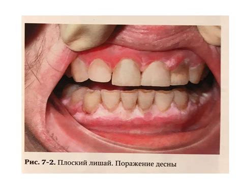 Изменения слизистой оболочки рта при дерматозах Красный плоский лишай