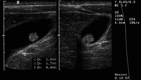 Sonographic Image Of The Gallbladder Polyp In Case 2 55 74 4 Mm