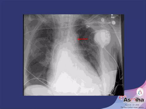 Iabp Principle Hemodynamic Timing Weaning 2016 Background Asmiha Isman Edit Pptx