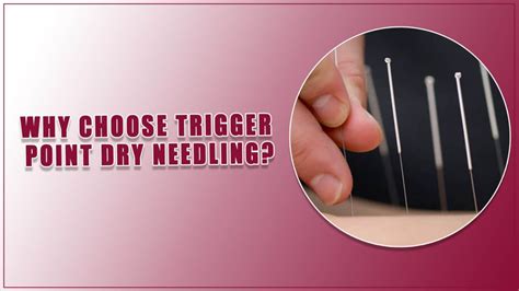 What To Expect From Reliable Trigger Point Dry Needling Expert Guide Lawtonphysicaltherapy