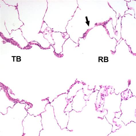 Presumptive Diffuse Aspiration Bronchiolitis In A 13‐year‐old Domestic