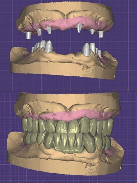 Yahya Salman On Linkedin Exocad Design Technician