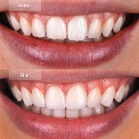 Teeth Shaved Down Before And After At Barbara Moser Blog