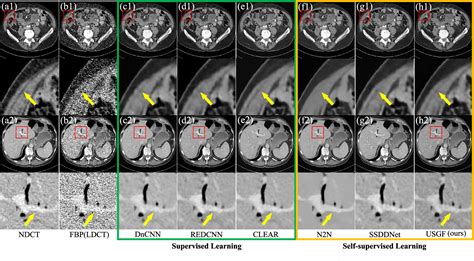 Figure 6 From Unsharp Structure Guided Filtering For Self Supervised Low Dose Ct Imaging