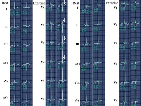 Findings Of The Treadmill Testing Before And After Surgery A Before Download Scientific