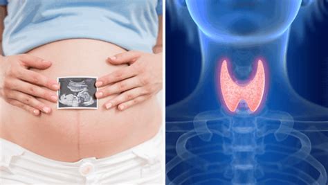 Embarazo E Hipotiroidismo Efectos En La Salud De La Madre Y El Bebé