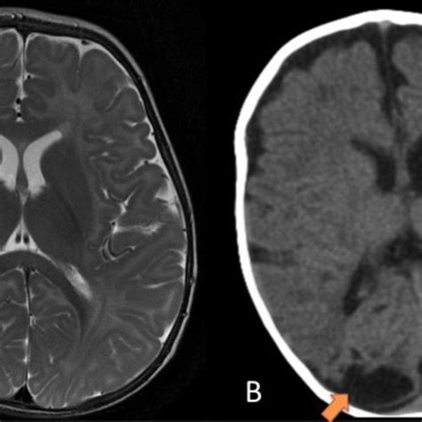 A Axial Non Contrast Ct Demonstrates Interval Hyperdensity Within The Download Scientific