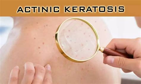 Bimiralisib Gel Shows Strong Efficacy For Early Stage Actinic Keratosis