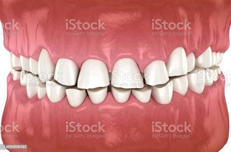 치아 감소 는 치아 조직의 손실을 초래합니다 치과용 3d 일러스트레이션 0명에 대한 스톡 사진 및 기타 이미지 0명 감각 지각 건강관리와 의술 Istock