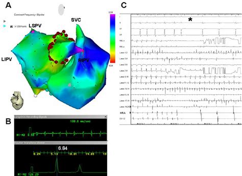 Figure 1 From Real Time Dominant Frequency Mapping And Ablation Of Dominant Frequency Sites In