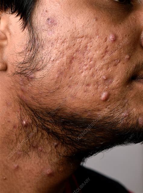 Cystic Lesions In Acne Stock Image C0372216 Science Photo Library