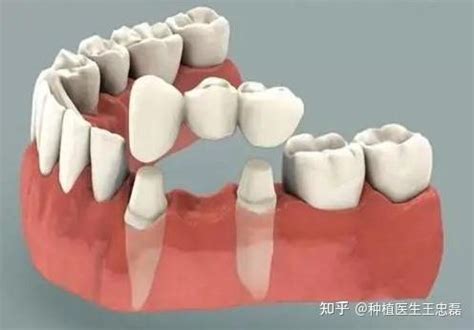 三种假牙方式的优缺点看清楚再选 知乎