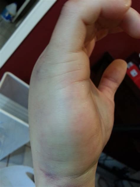 [serious] Broke My 4th Metacarpal And Have No Insurance Money Any