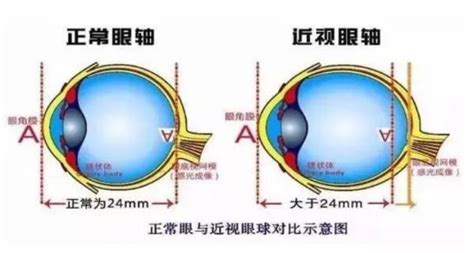 教你如何根据当前孩子眼轴长度计算未来孩子可能发展的近视度数