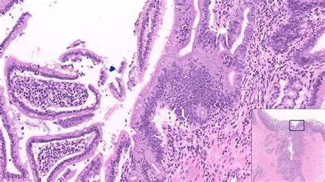 Ampulla Normal Histology Nus Pathweb Nus Pathweb