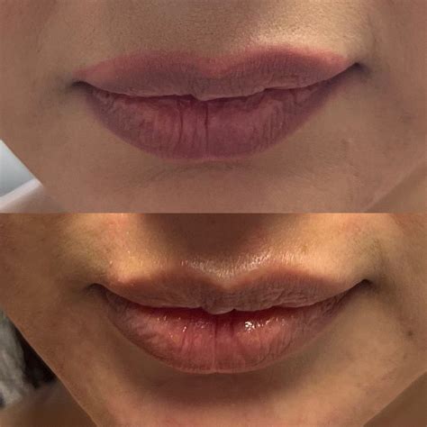 Laser Lip Plumping Everything You Need To Know