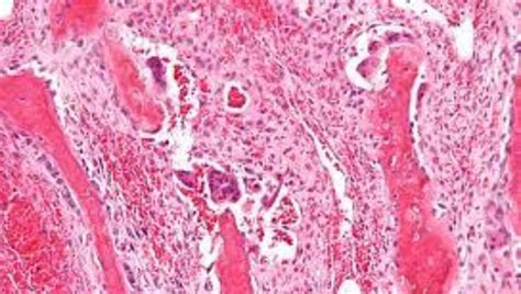 Hypercalcemia Medical Centric Hypercalcemia Medical Centric