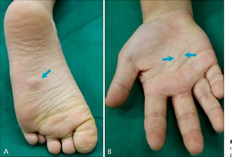 Pseudohypoparathyroidism Face