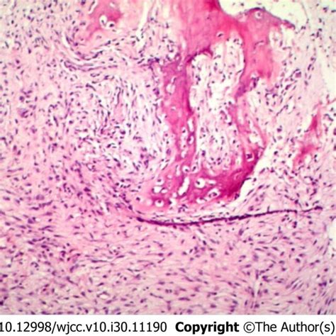 Histopathological Examination The Nuclei Are Hyperchromatic
