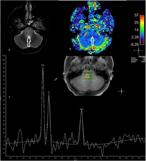 A C On Mri Perfusion A And B No Increase In Perfusion Is Observed In