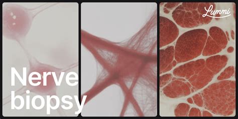 Nerve Biopsy Images — Free Hd Download On Lummi